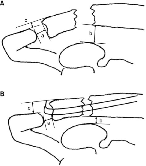 A Preoperative Radiologic Analysis A Acromioclavicular Distance Download Scientific Diagram