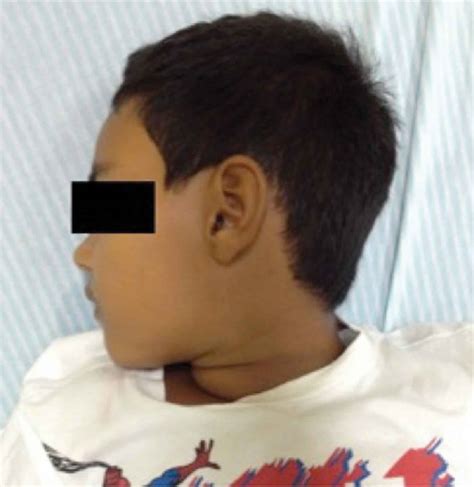 Grisel Syndrome Causes Signs Symptoms Diagnosis Treatment And Prognosis