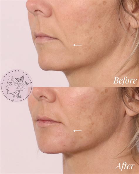 Radiesse For Cheeks And Lower Face Ultimate Image