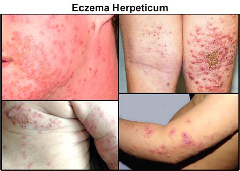 What Is Eczema Herpeticum Symptoms Diagnosis And Treatment Options