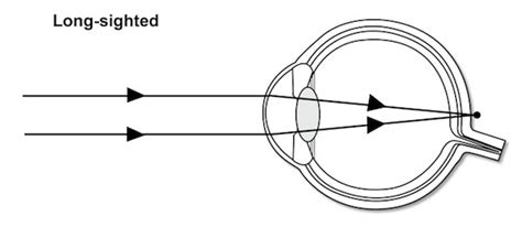 Long Sightedness Diagram Quizlet