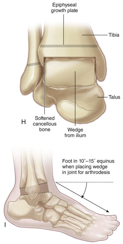 58 Arthrodesis Of The Ankle Joint Via The Anterior Approach Without
