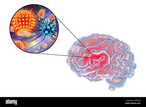 Viral Encephalitis Conceptual Illustration Showing Brain And Stock