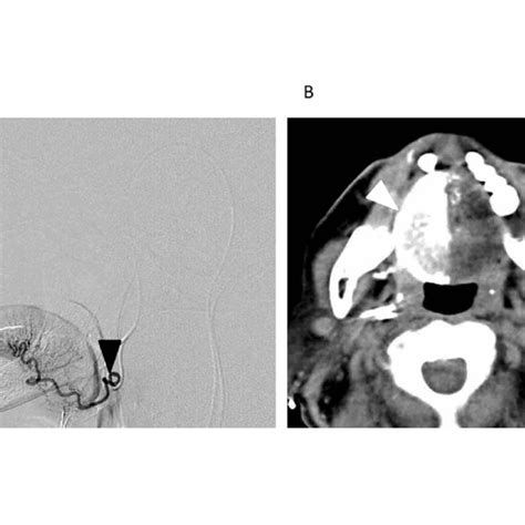 A Digital Subtraction Angiogram Dsa And An Axial View Of The Download Scientific Diagram