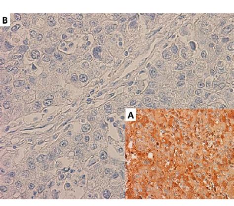 Afp Staining Of Recurrent Tumor Compared To Positive Control At Download Scientific Diagram