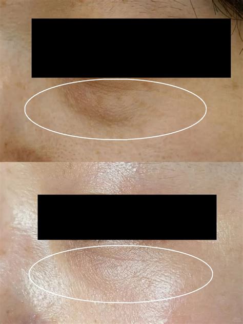 Exosomes Under Eyes Before And After Benefits And Result Dermax