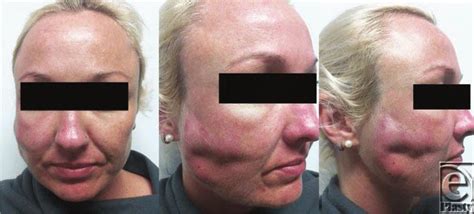 Massive Abscess Due To Infection After Facelift Rbotchedsurgeries