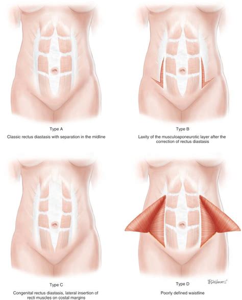 Surgical Approach To The Rectus Diastasis Clinical Tree