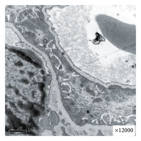 Electron Microscopy Irregular Thickening Of The Gbm And The Fusion Of