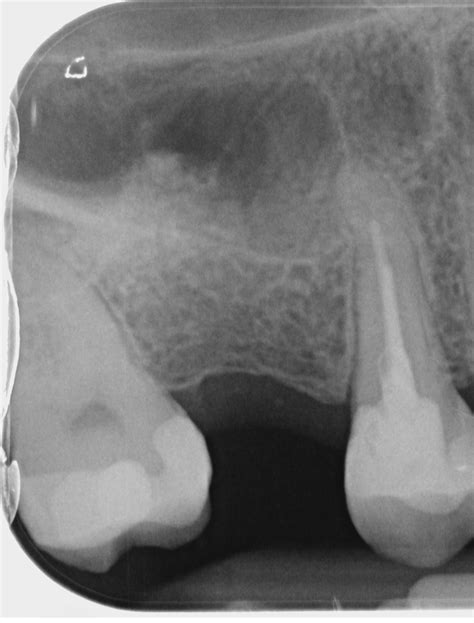 Wel Of Geen Definitieve Kroon Op Discutabele Kies Tandartsnl Forum