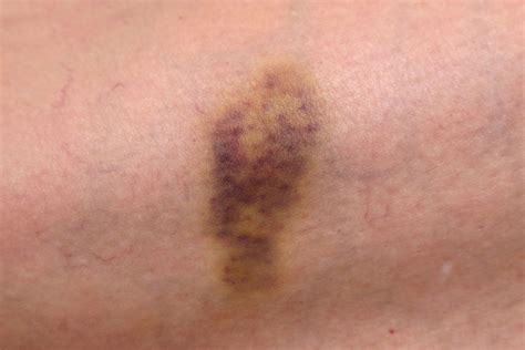 Leukemia Symptoms You Shouldnt Ignore Readers Digest