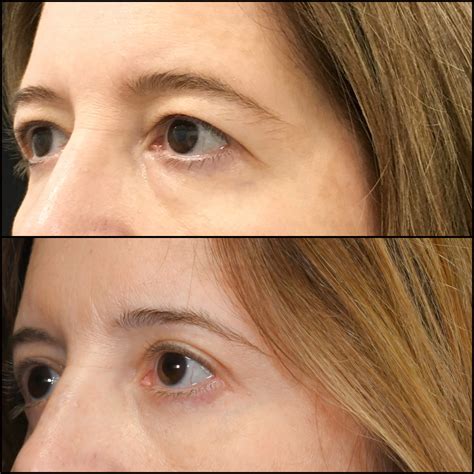 Upper Blepharoplasty Before And After Photos Flora Levin Md