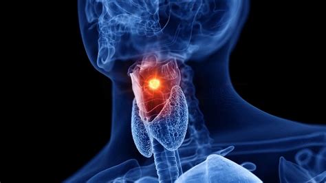 Understanding Throat Cancer Types Treatments And Preventions