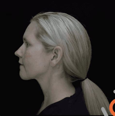 Patient 55345114 Myellevate Before And After Photos Virginia