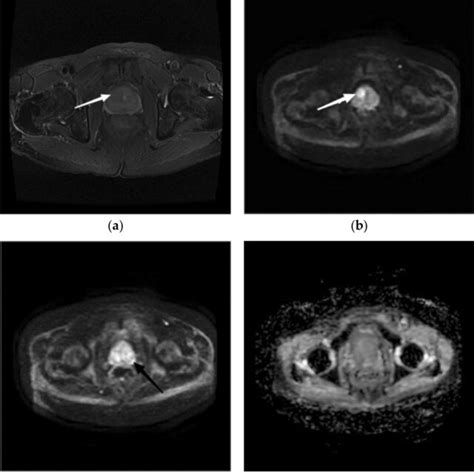 an 80 year old patient with a pi rads v2 1 score of 3 3 transition