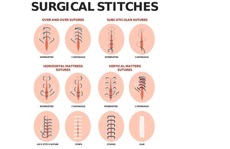Silk Suture Uses Advantages And Limitations Explained