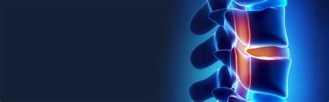 Disc Herniation Herniated Spinal Disc