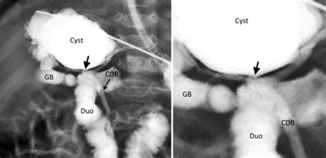 Ptc Sequentially Visualized The Cyst The Bilateral Hepatic Ducts The