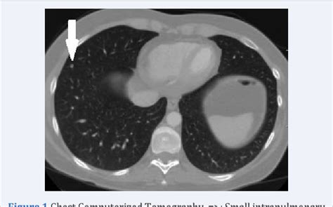 Figure 1 From Dye Marking Via Electromagnetic Navigation Bronchoscopy Enb A New And