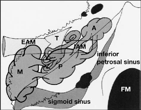 Groove Of Temporal Bone For Sigmoid Sinus Semantic Scholar
