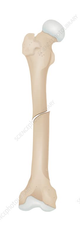 Oblique Displaced Femur Fracture Illustration Stock Image C060