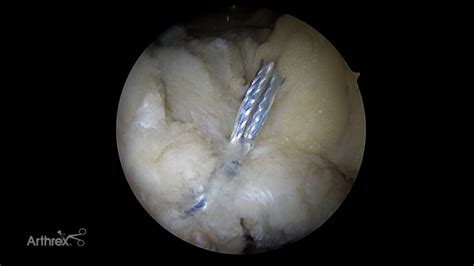 John Gualdoni On Linkedin Hip Capsular Closure Using The Looploc