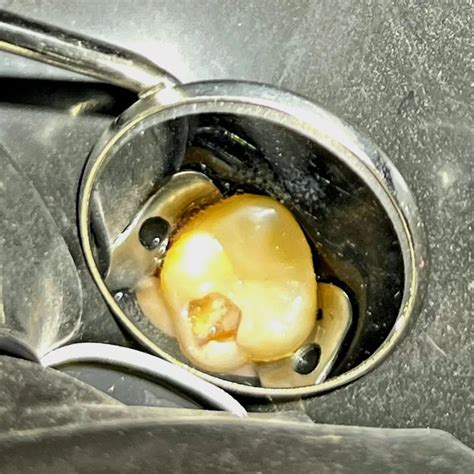 👉sabes Que Es El Hmi ️ El Hmi Es Clínica Dental Ríes