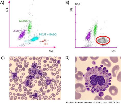 Persistent Platelet Sattelitism Despite Normal Platelet Counts