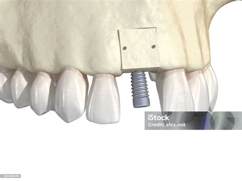 뼈 이식 뼈의 블록을 사용하여 확대 치아 이식 의학적으로 정확한 3d 일러스트레이션 감소에 대한 스톡 사진 및 기타 이미지 감소 건강관리와 의술 디지털 생성 이미지