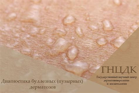 Буллезные дерматозы 🤔 🔹 Это обширная группа заболеваний общим клиническим признаком которых