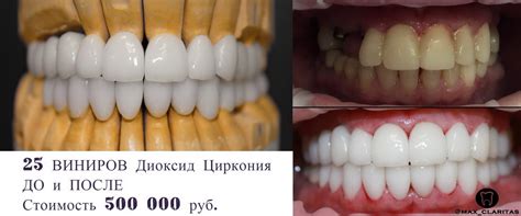 Виниры Спб стоимость, виниры на зубы цена