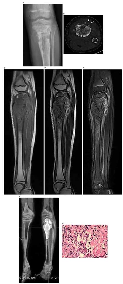 Osteosarcoma In A Female Patient Aged 10 Years Osteosarcoma Of Left Download Scientific