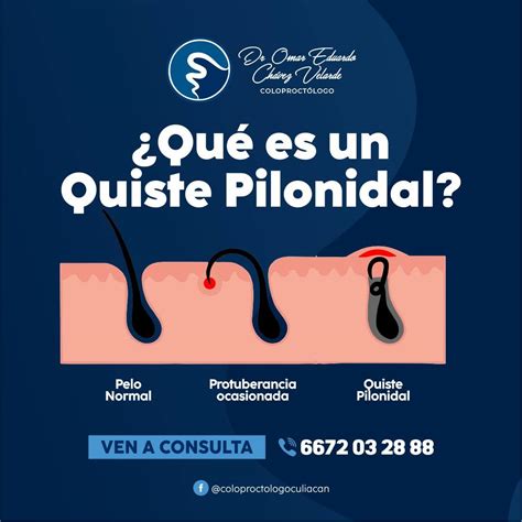 Dr 🔍 ¿qué Es Un Quiste Pilonidal 🔍 El Quiste Pilonidal Es Una Pequeña Bolsa Que Se Forma En