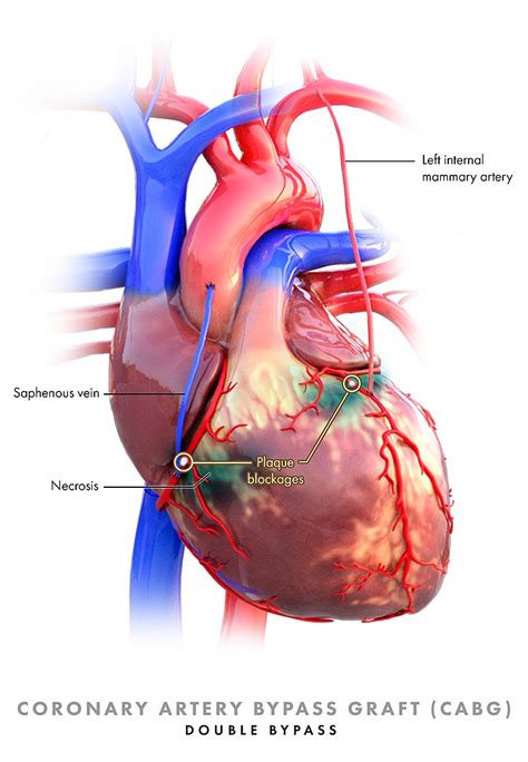 Filecoronary Artery Bypass Graft Double Bypass Wikimedia Commons