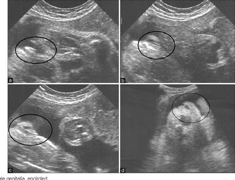 Figure From The Accuracy Of D Ultrasound Prenatal Sex Determination Semantic Scholar