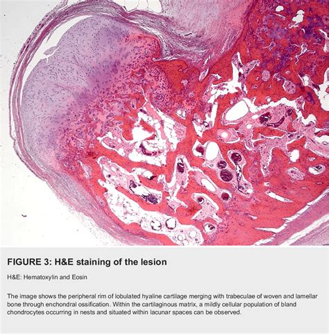 Figure 3 From Heavily Ossified Soft Tissue Chondroma Of Plantar Foot