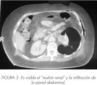 Pielonefritis Enfisematosa Comunicación De Un Caso
