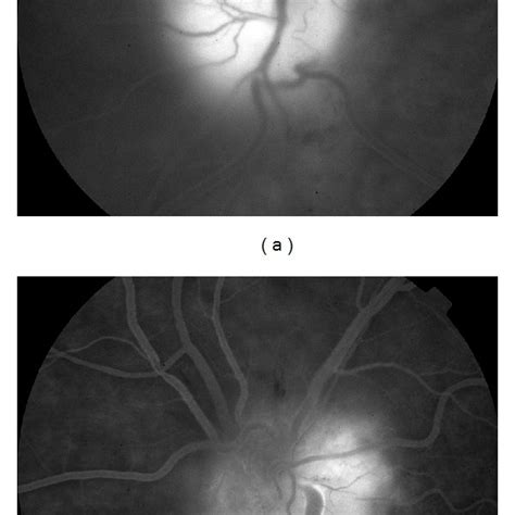 Test Results Of Humphrey Visual Field Superior Altitudinal And Central Download Scientific