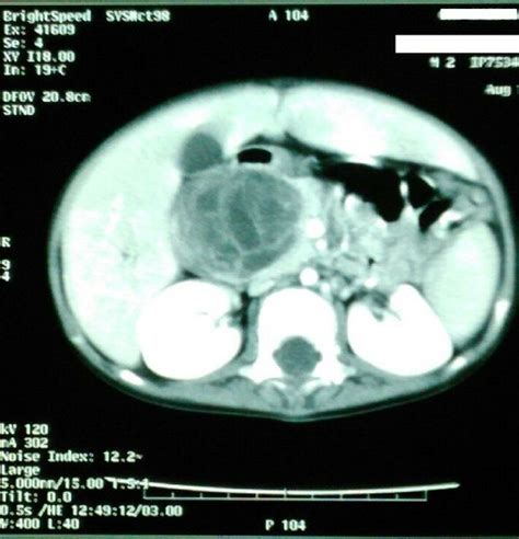 Post Contrast Ct Scan At The Level Of The Hepatic Hilum Showing Dilated