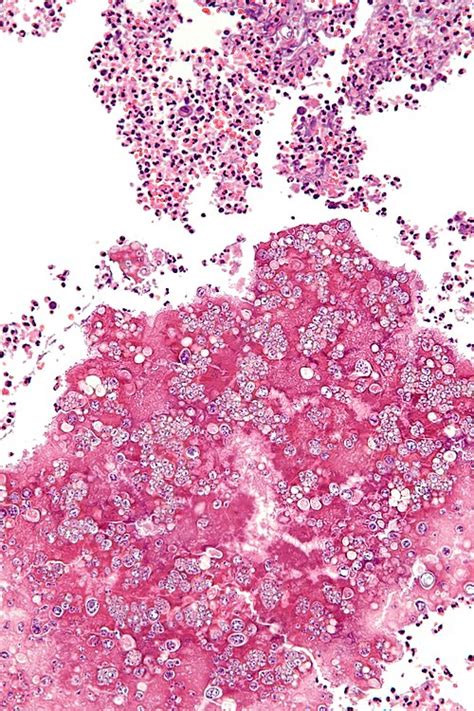 Case 54 Libre Pathology