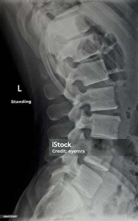 Lumbar Vertebrae X Ray