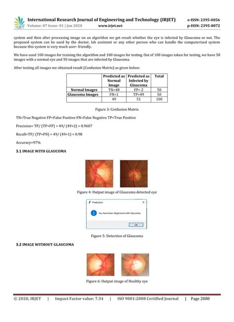 Irjet Glaucoma Detection Using Convolutional Neural Network Pdf