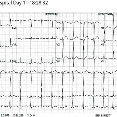 Ecg At Admission Of A Patient With Hyperkalemia Serum Potassium 9 4 Download Scientific