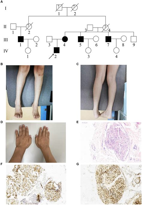 Frontiers Clinical Neurophysiological Evaluation And Genetic