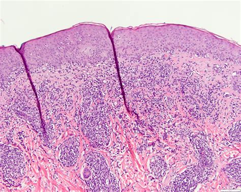 Pathology Outlines Mycosis Fungoides Subtypes