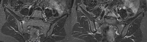 High Prevalence Of Sacroiliac Bone Marrow Edema On Mri In Post Partum