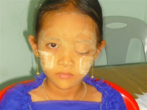 Tha Zin From Burma Raised 1500 To Get Healthy Watsi