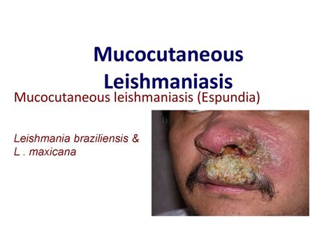 What Is Leishmaniasis Disease At Tommie Moody Blog