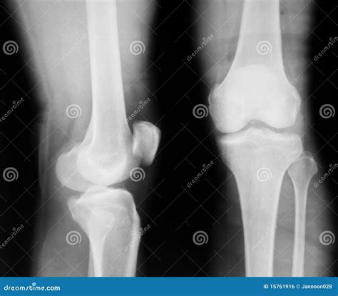 X Ray Human Knee Joints Finding Fracture Proximal Metaphysis Of Tibia Healthcare And Insurance