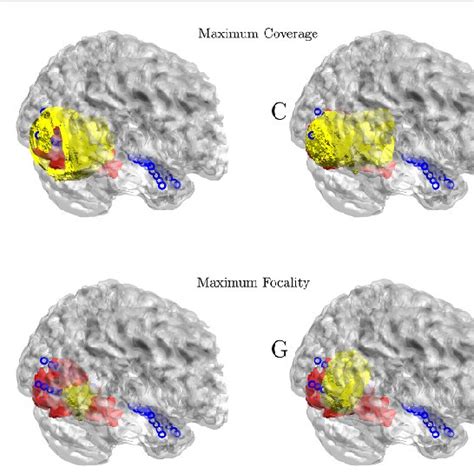 Example Of Temporal Interference Stimulation Ti Using Desm The Left
